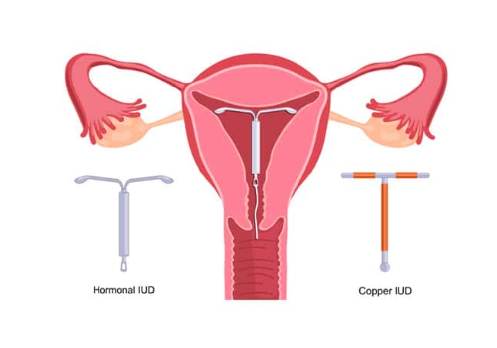 Copper & Mirena IUD Insertion + Differences & Benefits - Dr.Azarmidokht Shojaei
